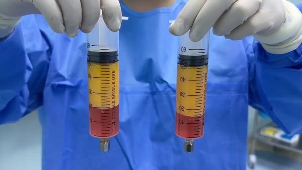 Micro Liposuction – Dr Sandy Medical Spa